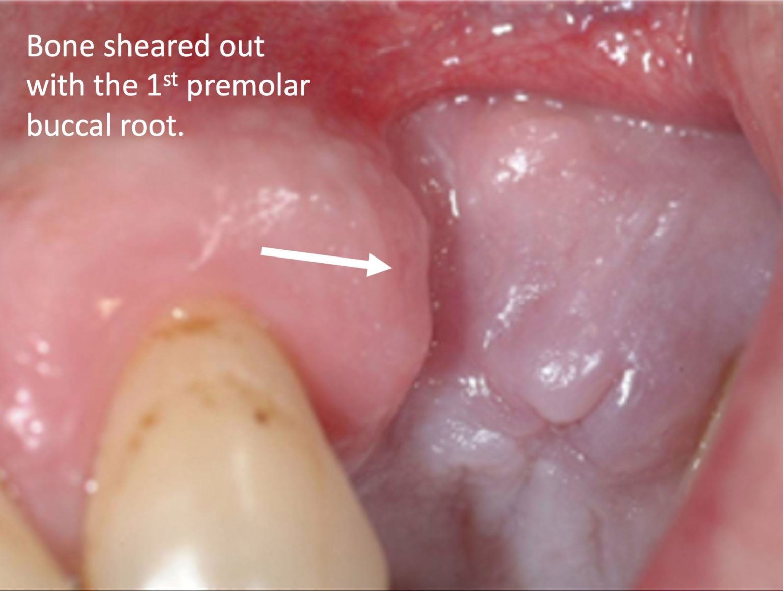 Easier Maxillary First Premolar Extractions for General Dentists ...