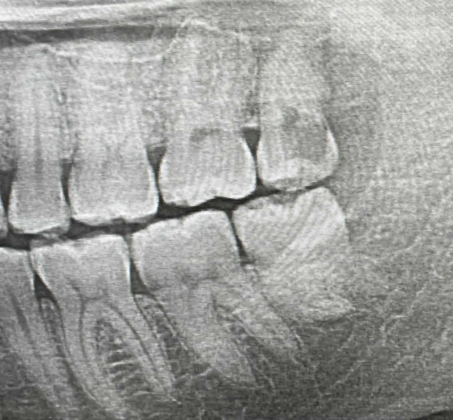 Walk Through Critical Steps in a Challenging Third Molar Extraction ...